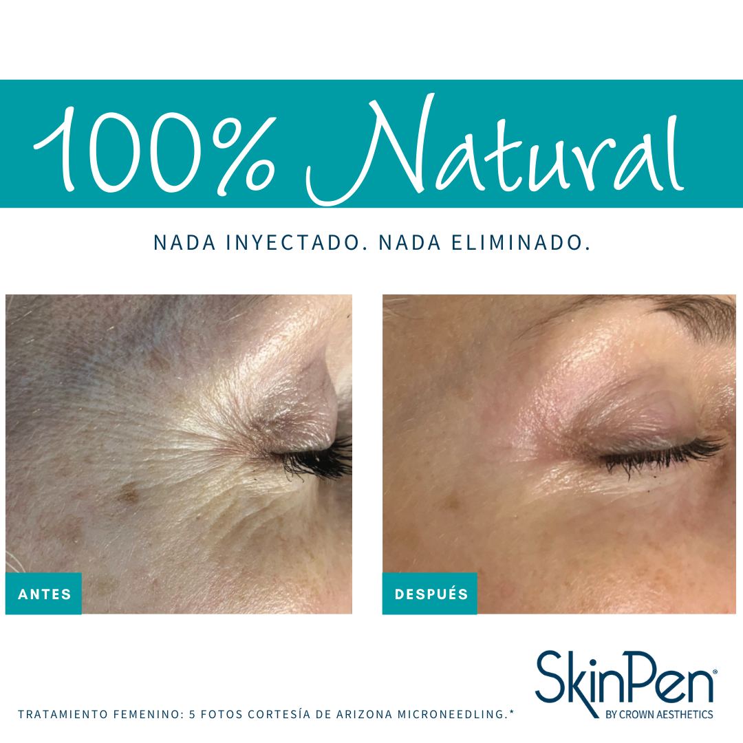 Recupera la mejor versión de tu piel con SkinPen® Precision